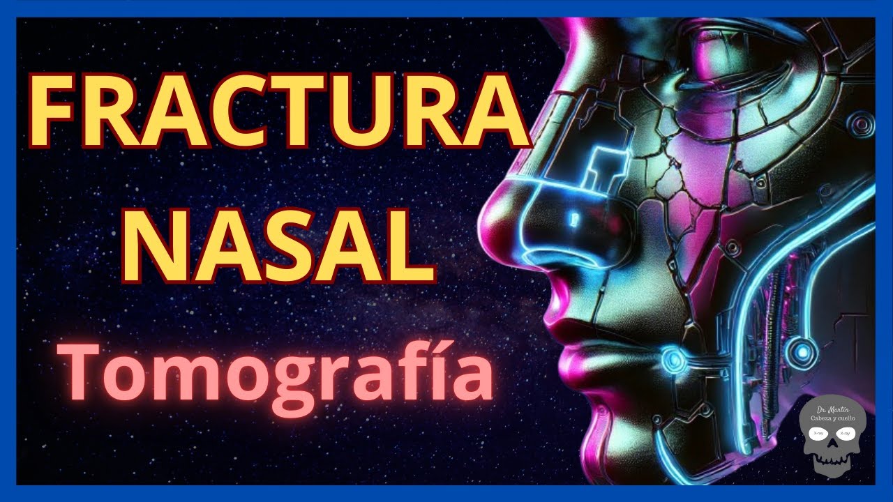 Fractura Nasal en Tomografía 🩻👃 Hallazgos Claves - YouTube
