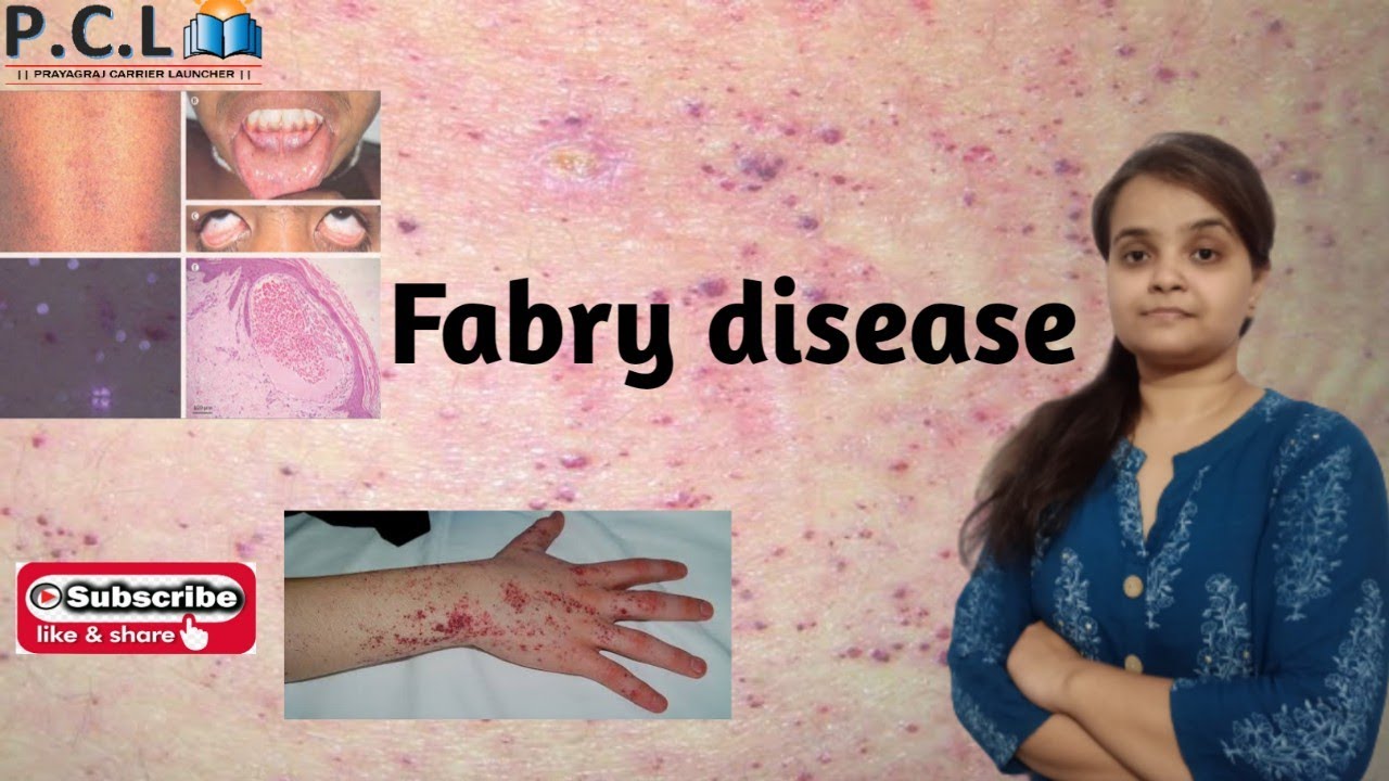 FABRY DISEASE - YouTube