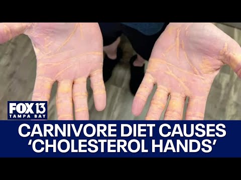 Florida man on carnivore diet developed ‘cholesterol hands’: JAMA