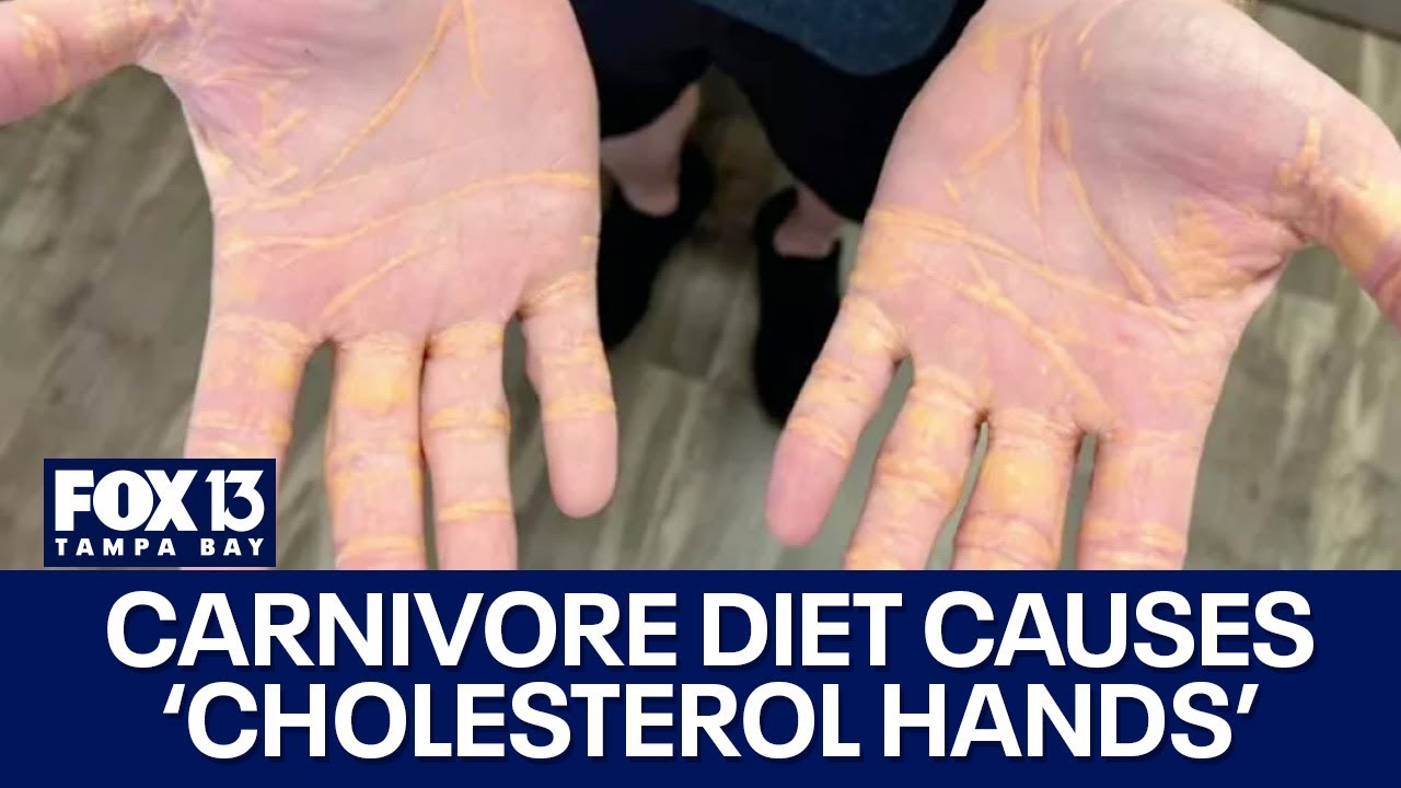Florida man on carnivore diet developed ‘cholesterol hands’: JAMA - YouTube