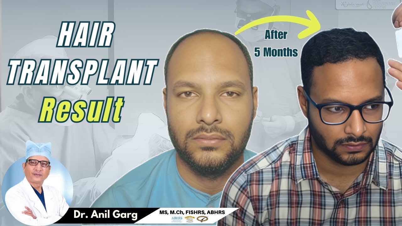 Hair Transplant in Indore | Best Results & Cost of Hair Transplant in Indore | FUE Hair ...