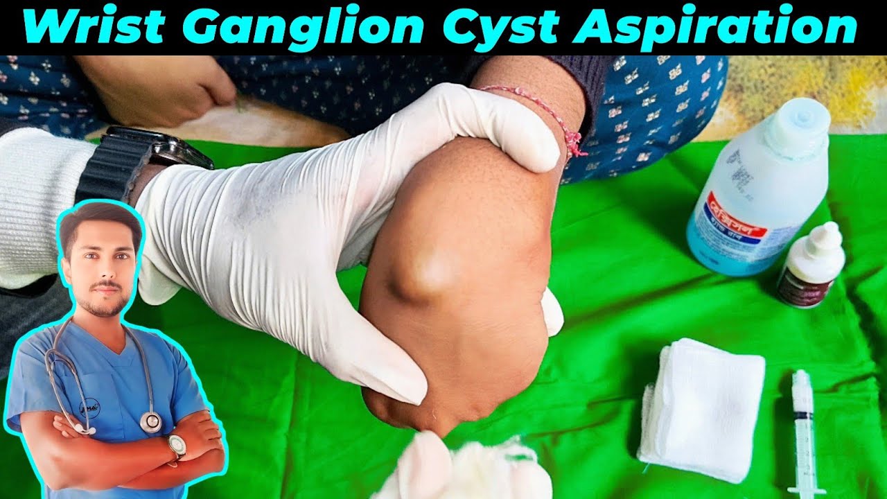 Ganglion Cyst Removal: Safe & Effective Aspiration Procedure ... Ganglion Cyst Removal: Safe & Effective Aspiration Procedure ...