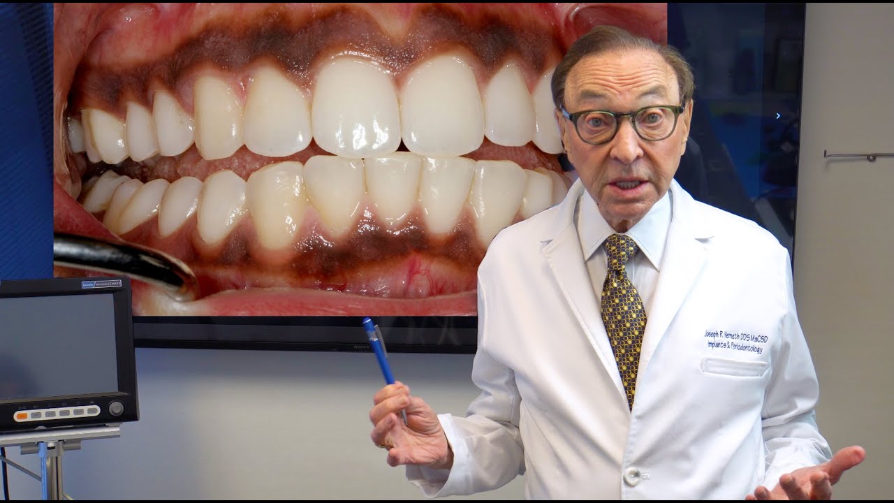 DARK Pigmented GUMS? Brighten Your Smile With Gum Depigmentation! - YouTube
