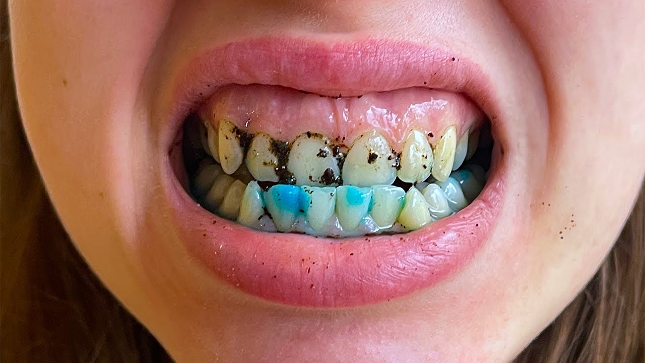 Cleaning Teeth from Food/Very dirty teeth/dirty blue tongue - YouTube