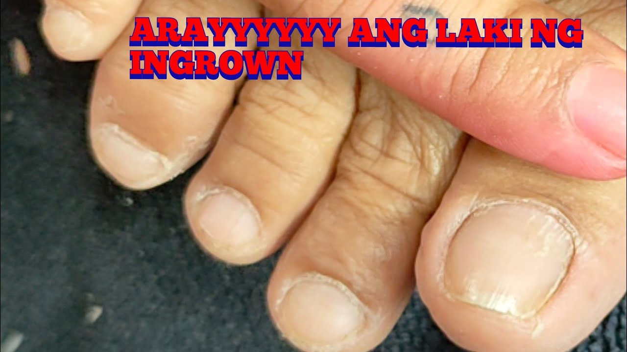 Subrang sakit ang ingrown - YouTube
