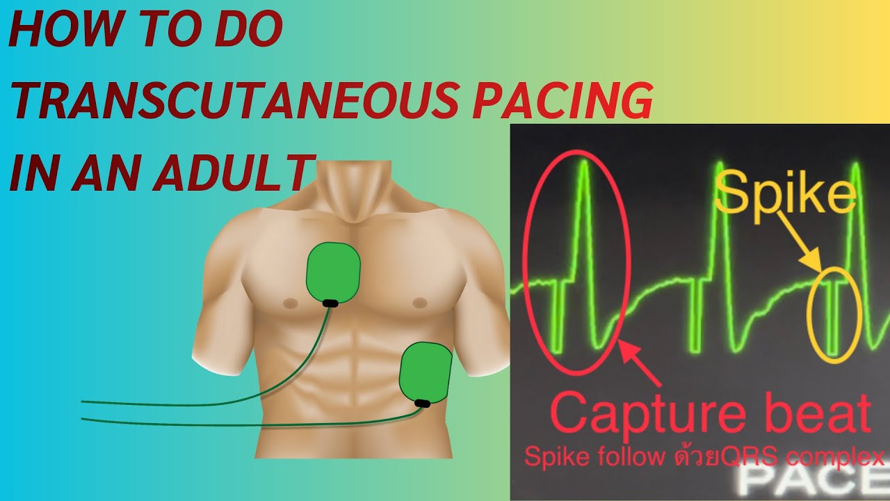 สาธิตวิธีการทำ Transcutaneous Pacing (ฉบับเตรียมสอบ 5 นาที) - YouTube