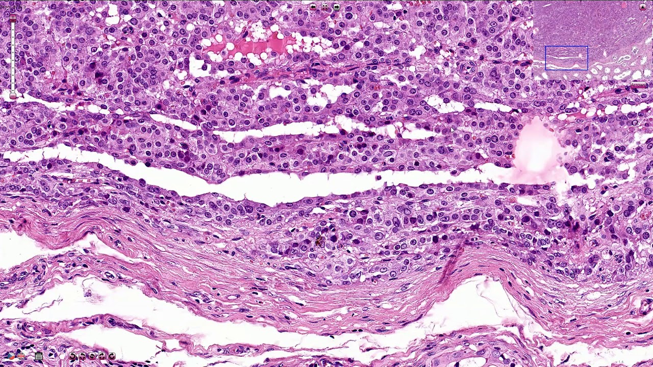 Leydig Cell Tumor - Ovary, Histopathology - YouTube