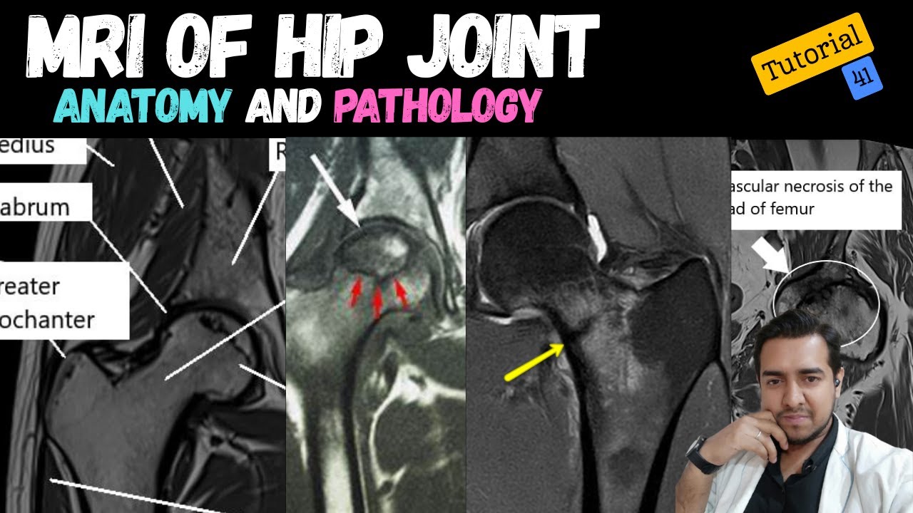 MRI Hip joint Anatomy and Some common Pathology | MRI Technique Course ...