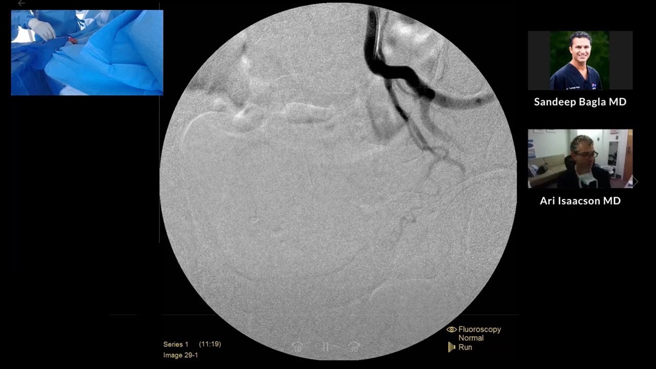 TruSelect™ Microcatheter Live Case Recording - YouTube
