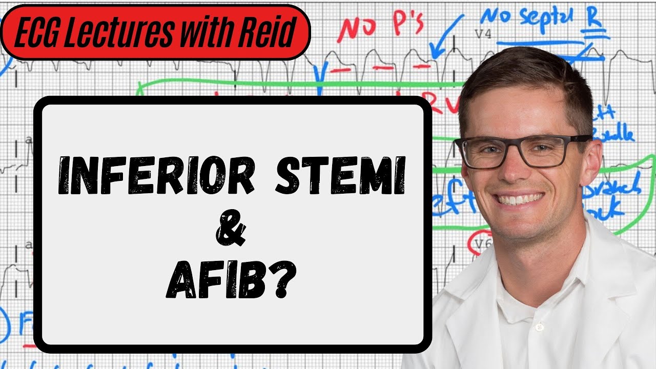 AFib + STEMI | Day 25 ECG Challenge - YouTube