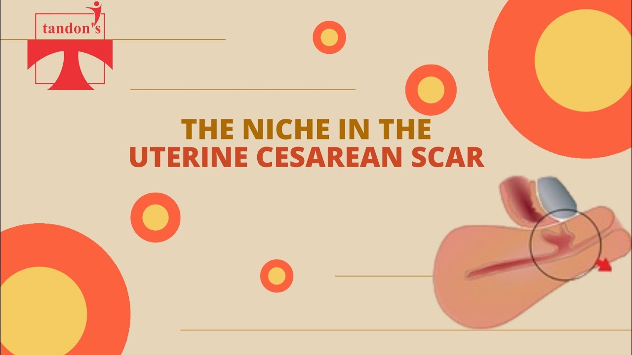 Cesarean section scar defect or niche #ultrasound #youtube #sonogram # ...