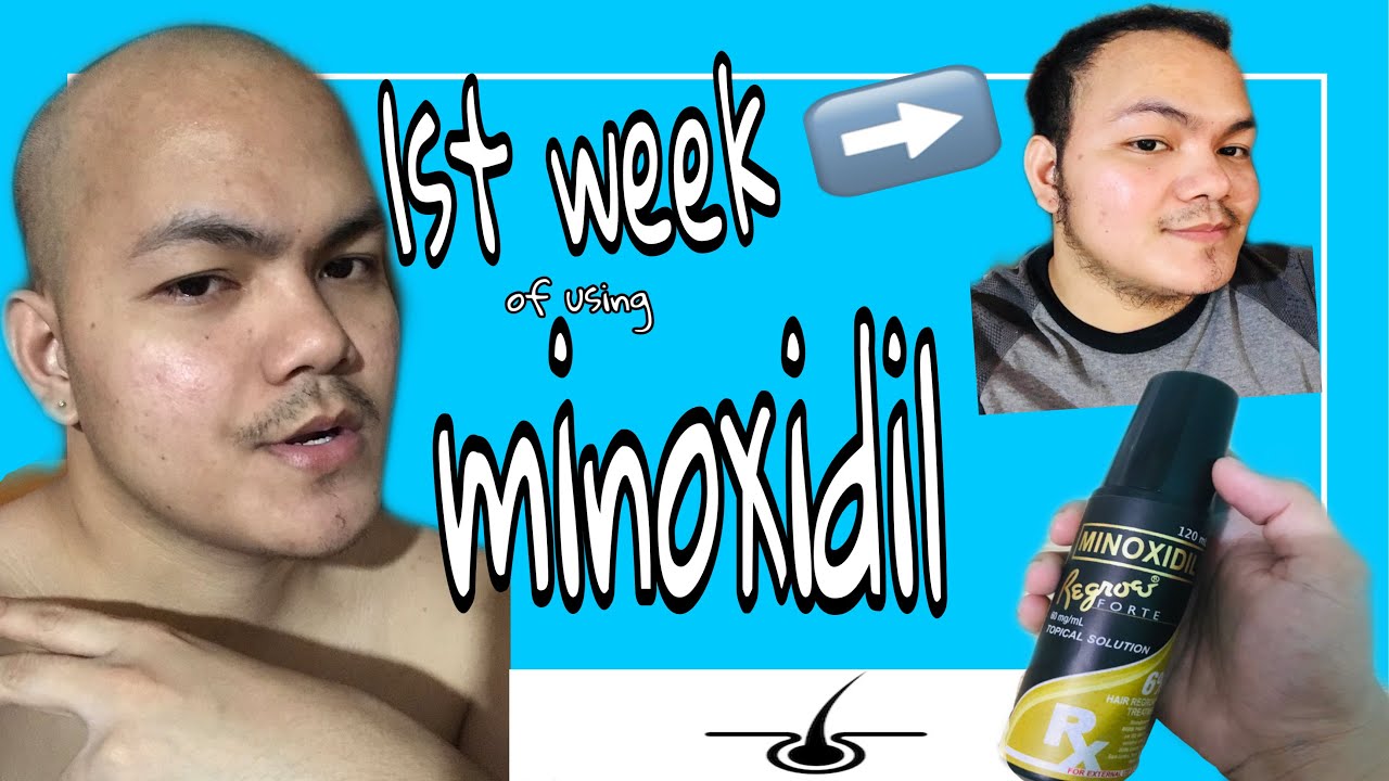 Minoxidil Regroe 6% - after 1st week of using minoxidil for hairloss or ...