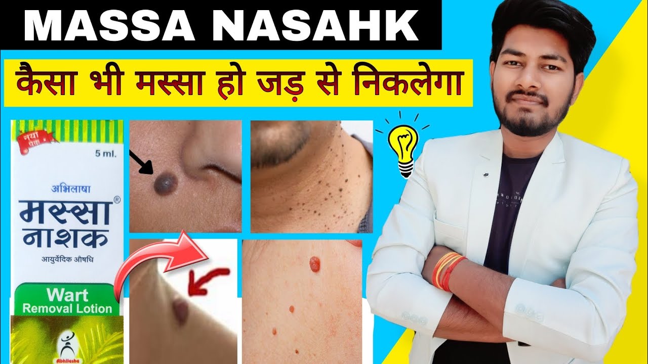 मस्से की दवा - Massa Nashak Lotion | Wart Removal Lotion | मस्सा नाशक ...