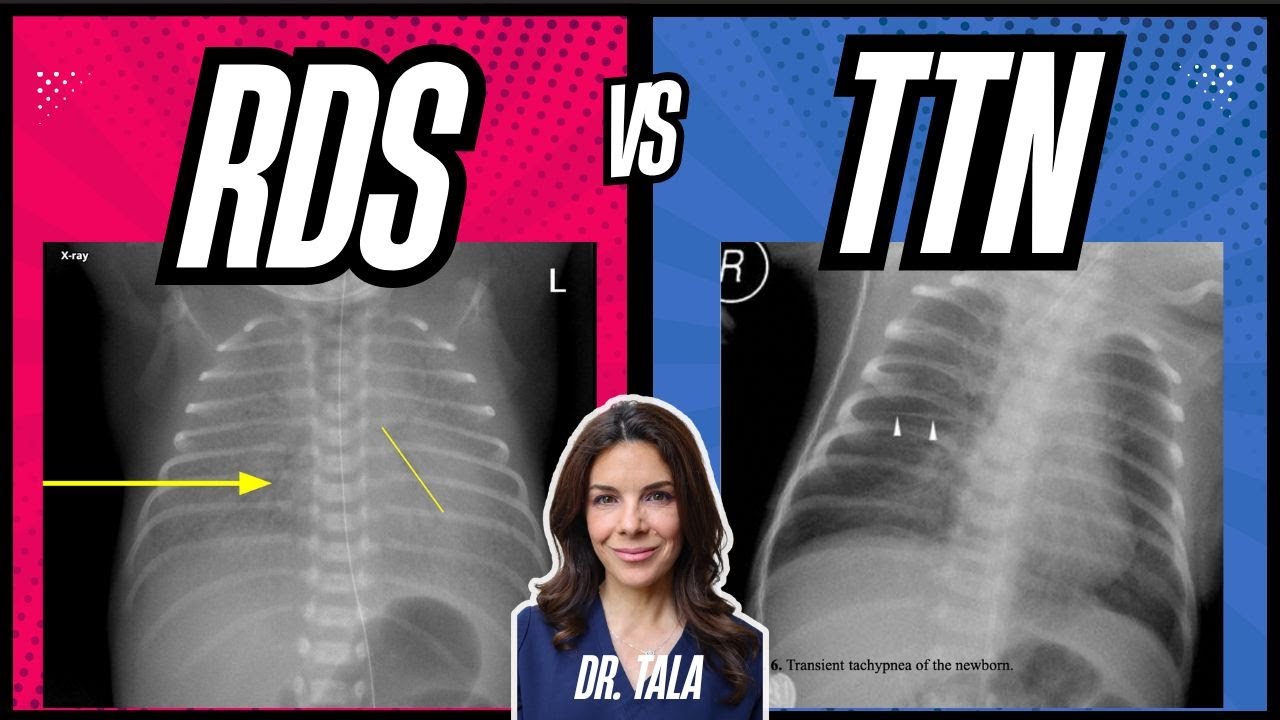 PLAY the GAME! Respiratory Distress Syndrome or Transient Tachypnea of ...