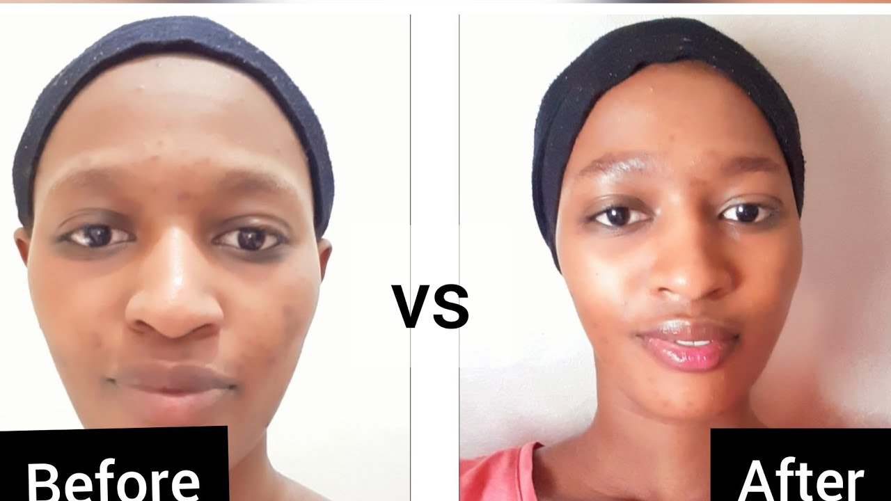 Get rid of black spots on your face|stimming|Kenyan in Dubai - YouTube