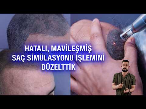 Saç simülasyonu silme ve düzeltme işlemi | Diyarbakır Saç Simülasyonu