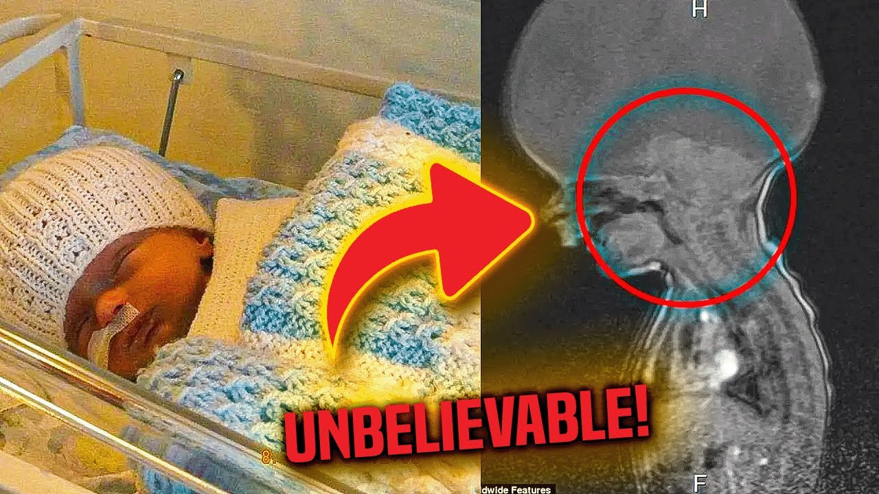 Child Born Without a Brain Survives,What Happened After 3 Years Will ...