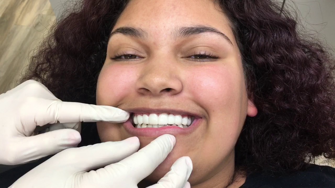 Houston Cosmetic Dentist...Get rid of that flipper with removable ...