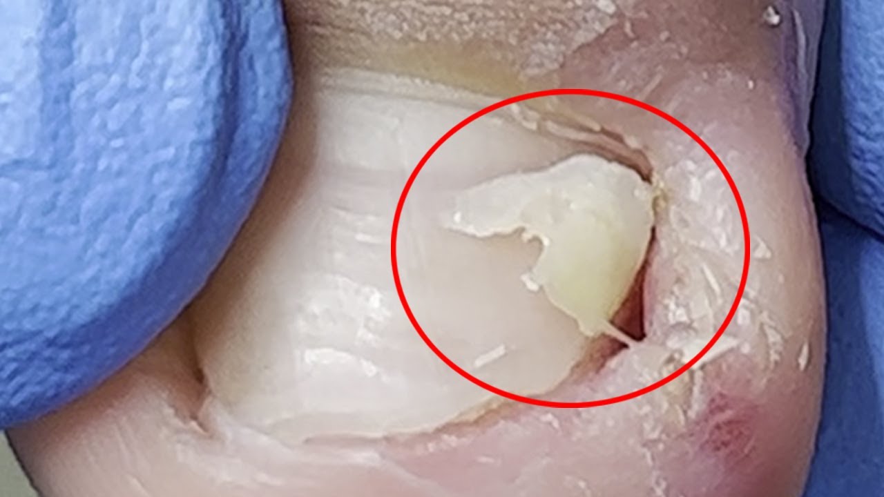 Huge ingrown nails & toenails heal quickly【Xue Yidao】 - YouTube