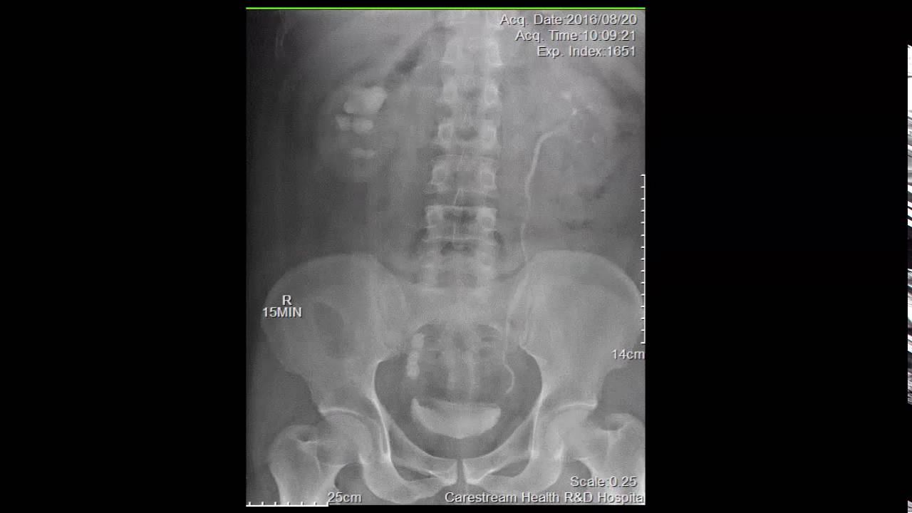 CASE 222 IVP immediate dense peristent nephrogram - YouTube