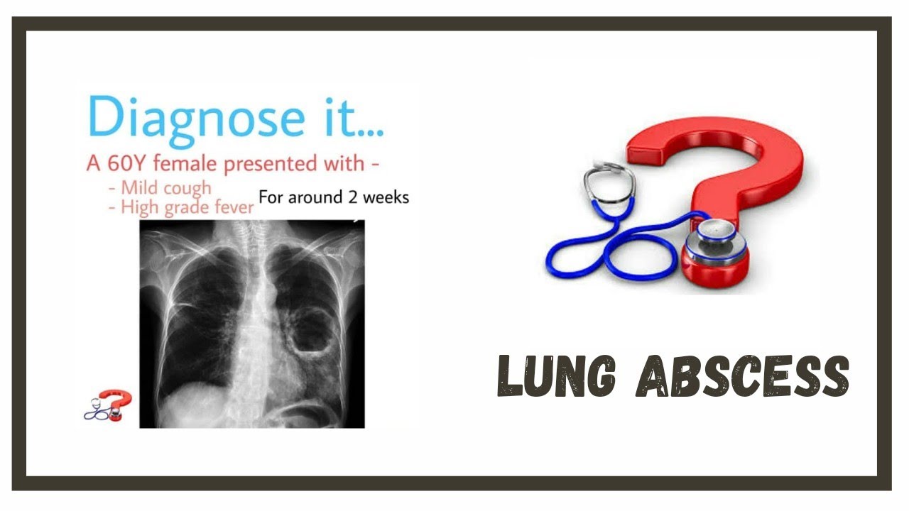 Chest xray interpretation - Lung abscess - YouTube