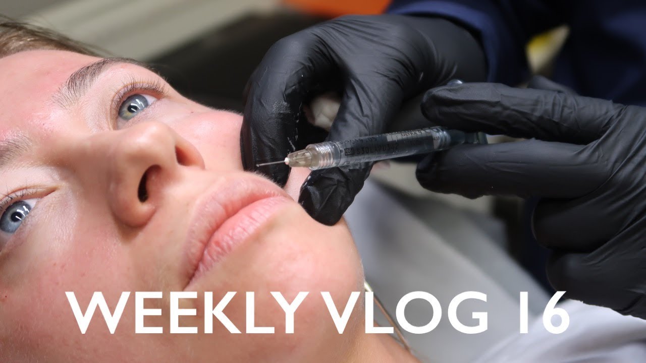 VLOG 16 | LIP FILLERS, BOTOX & DIY | CARLY GREGORY - YouTube