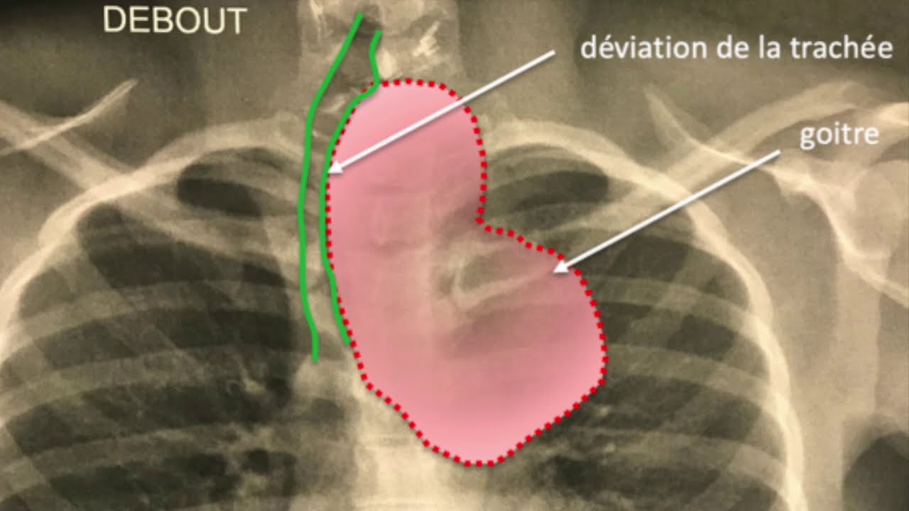 Chirurgie du goitre avec abord cervico-thoracique - YouTube