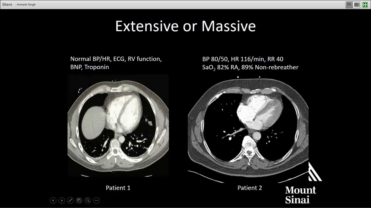 Endovascular Therapy for Acute Pulmonary Embolism - YouTube