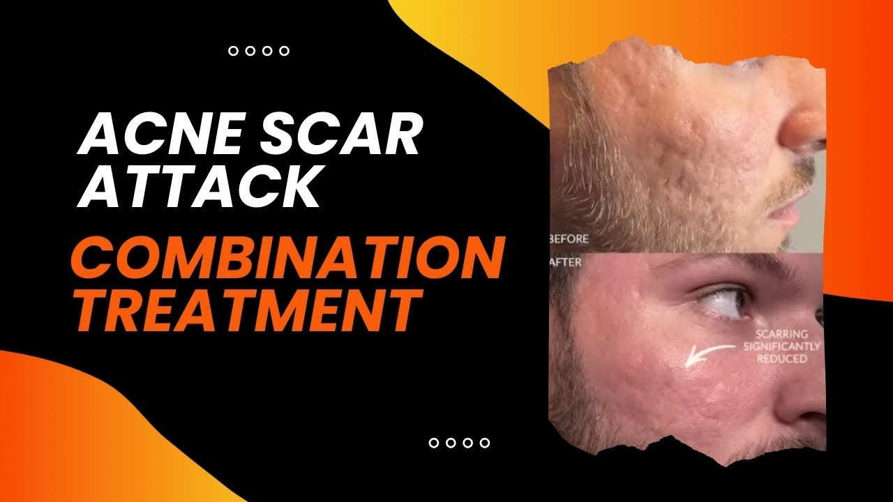 ACNE SCAR ATTACK | COMBINATION TREATMENT - YouTube