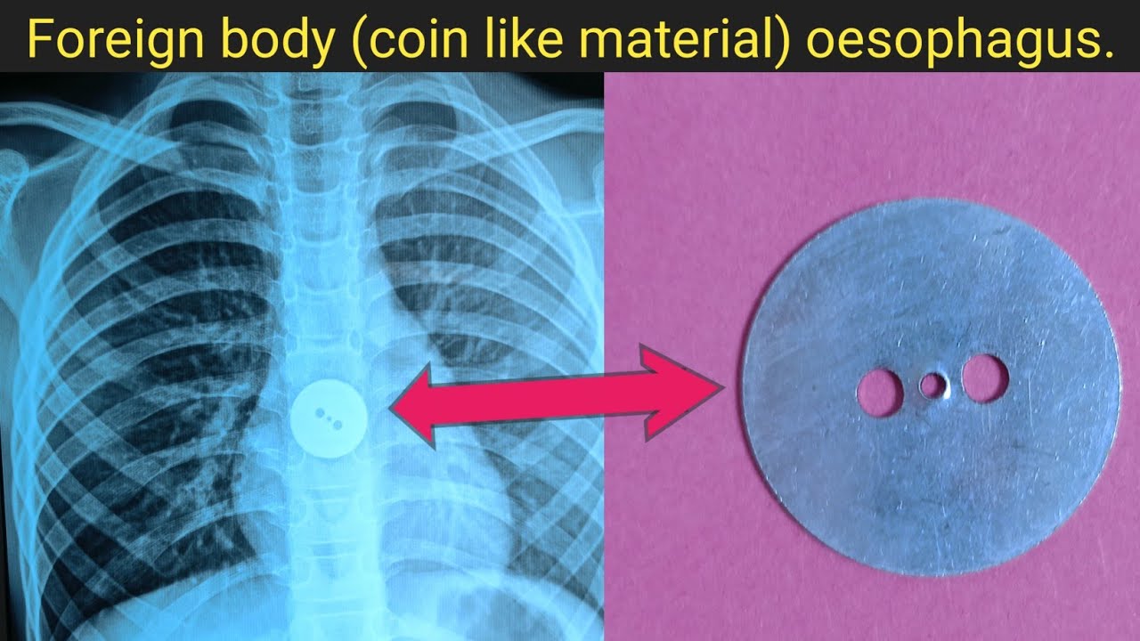 Foreign body (coin like material) oesophagus || #Endo_Cut - YouTube