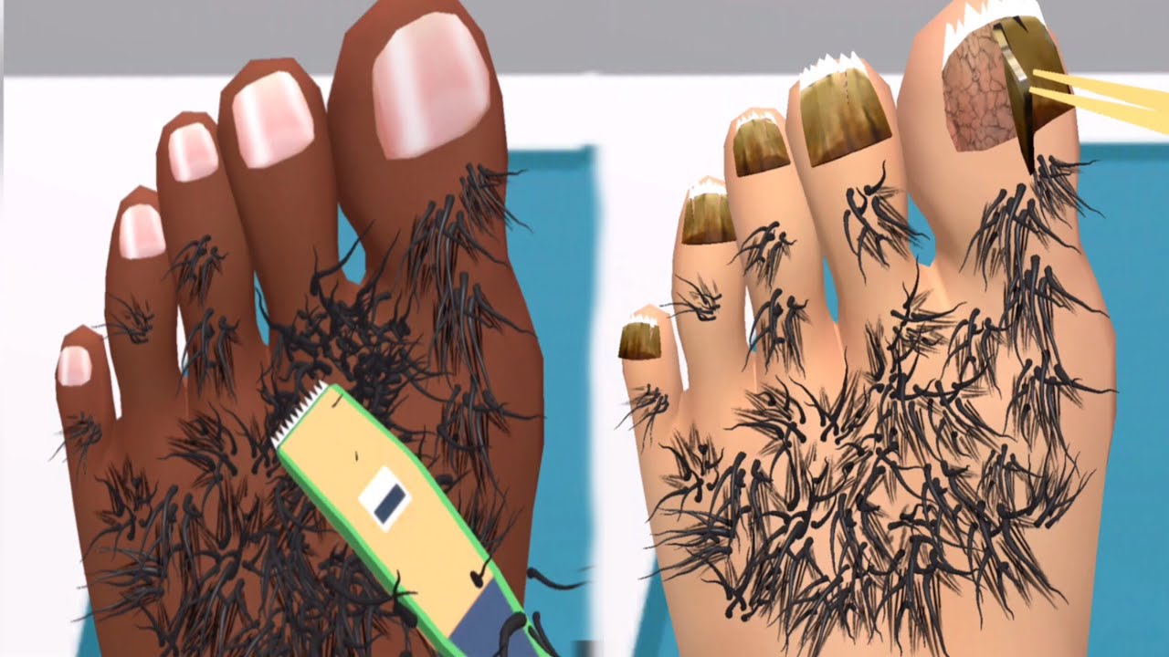 Ingrown Toenail removal Podiatrist Treatment || Asmr Animation - YouTube