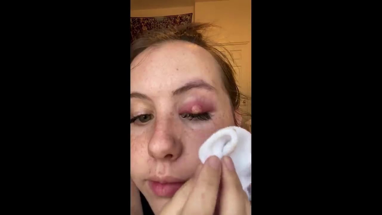 Major Satisfying Pimple Popping 2020 - Part 19 - YouTube