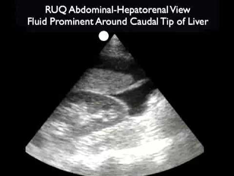 How to: FAST RUQ Exam - Hemorrhage - YouTube