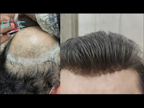 9899746489 Natural Hair Patch Service in Delhi | Amazing Frontline Hair ...