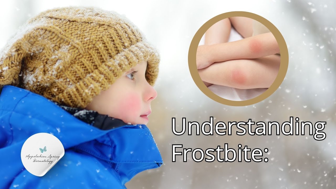Understanding Frostbite: Signs, Symptoms, and Risk Factors - YouTube