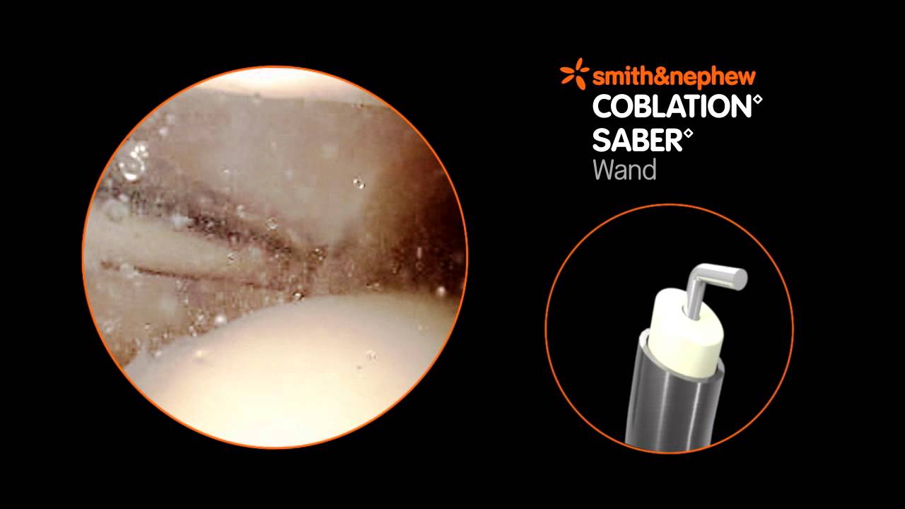 COBLATION Module 3 - COBLATION in the Knee - YouTube