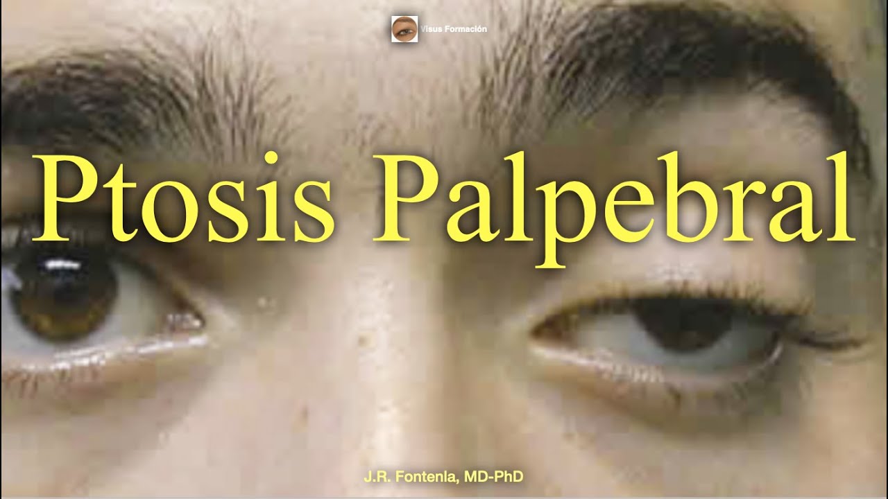 Ptosis Palpebral. - YouTube