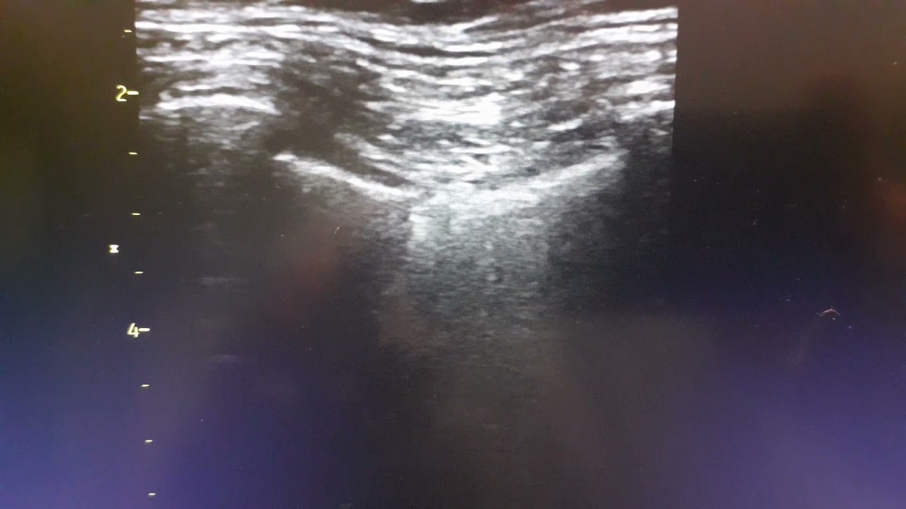 lung pulse - YouTube