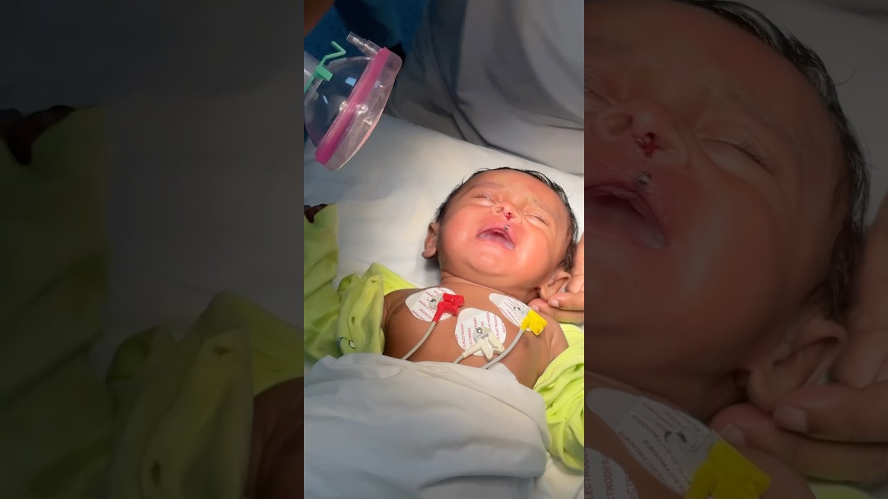 Baby surgery suture removal - YouTube