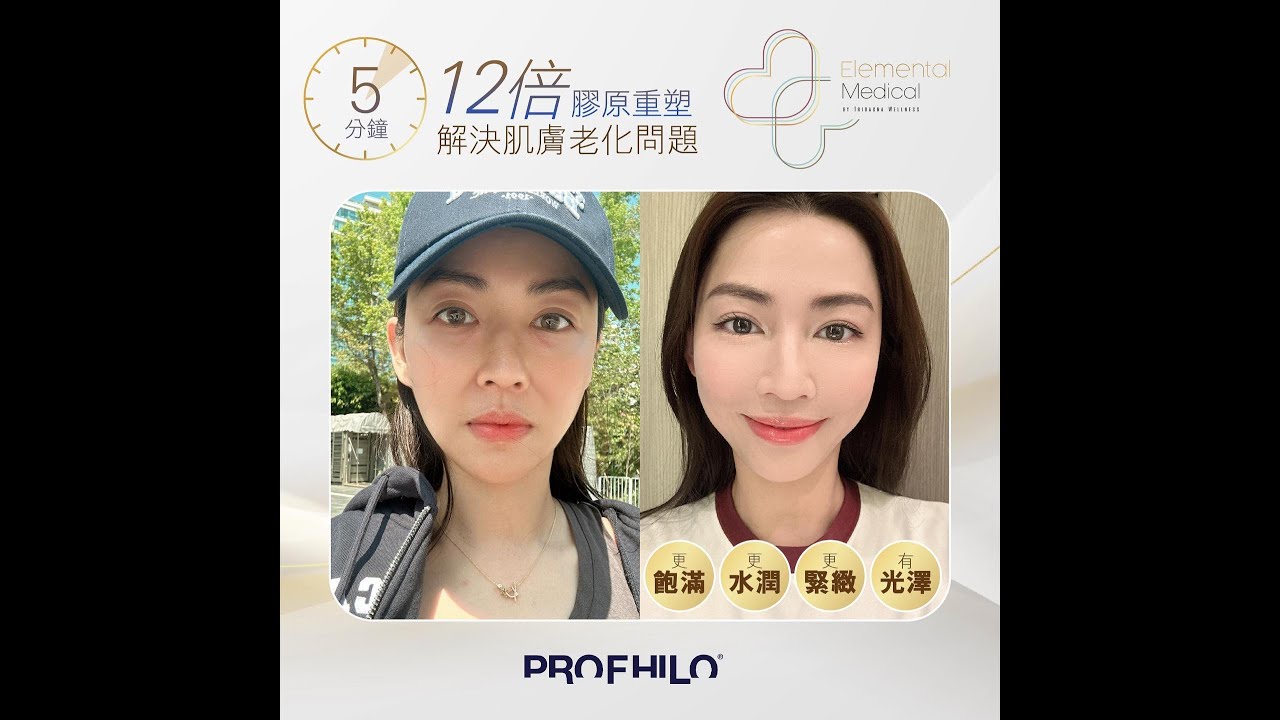 Profhilo逆時針 增加膠原及肌膚癒合能力 - YouTube