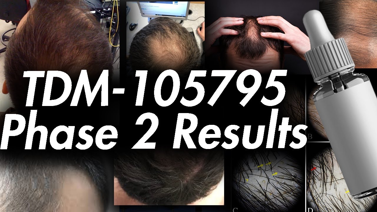 TDM-105795 Phase 2 Clinical Trial: Hair Growth Observed in Androgenetic ...
