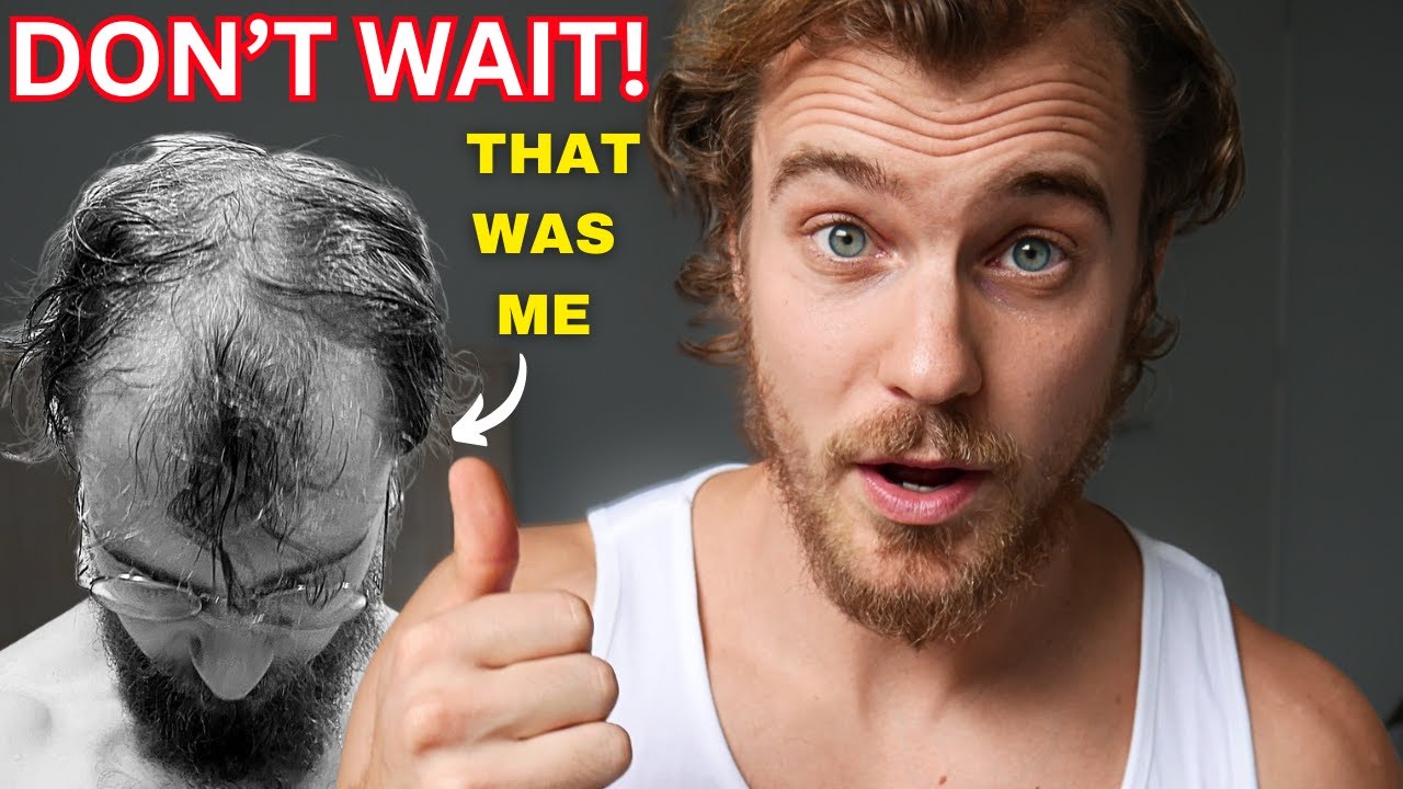 The 4 Balding Stages: WHAT TO DO BEFORE IT'S TOO LATE! (ultimate guide ...