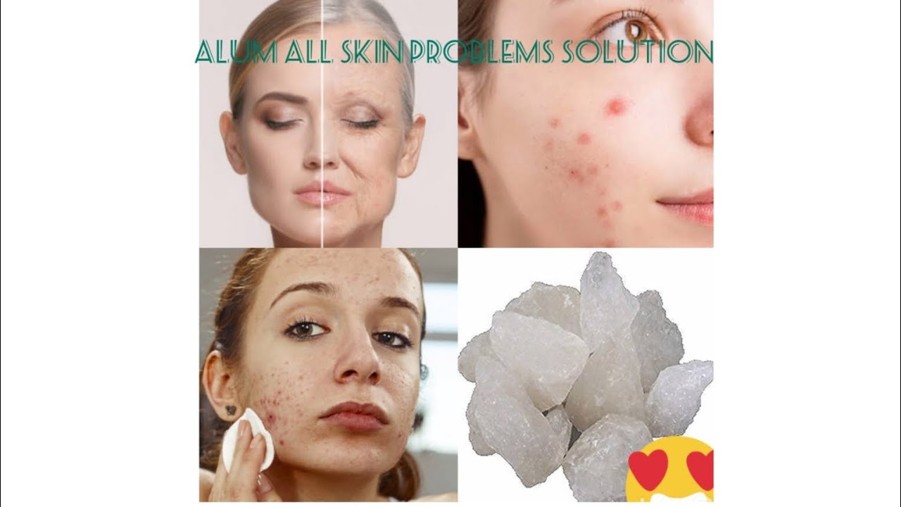 Alum all skin problems solution 🥰🥰#skincare ,#viral ,#beauty tips # ...