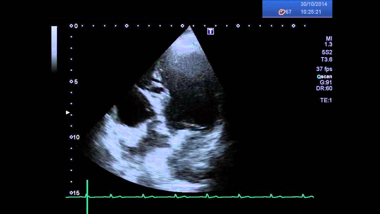 Cleft Ventricular - YouTube