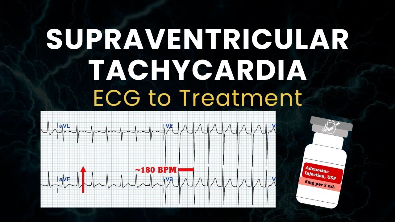 Supraventricular Tachycardia (SVT) | ECGs to Treatments - YouTube