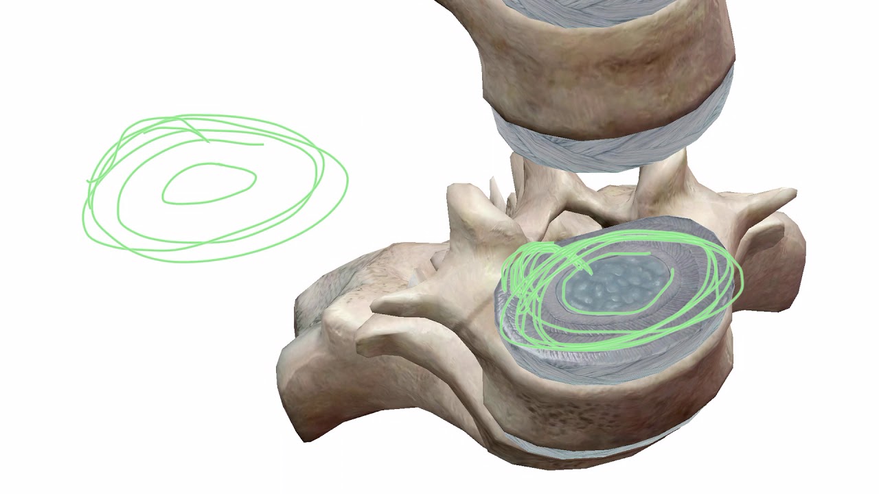 Disc Herniation What Is A Disc Protrusion Vs Disc Extrusion YouTube disc-herniation-what-is-a-disc-protrusion-vs-disc-extrusion-youtube