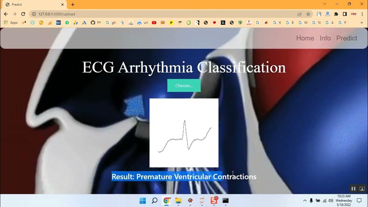 MInSC A VLSI Architecture for Myocardial Infarction Stages Classifier ...