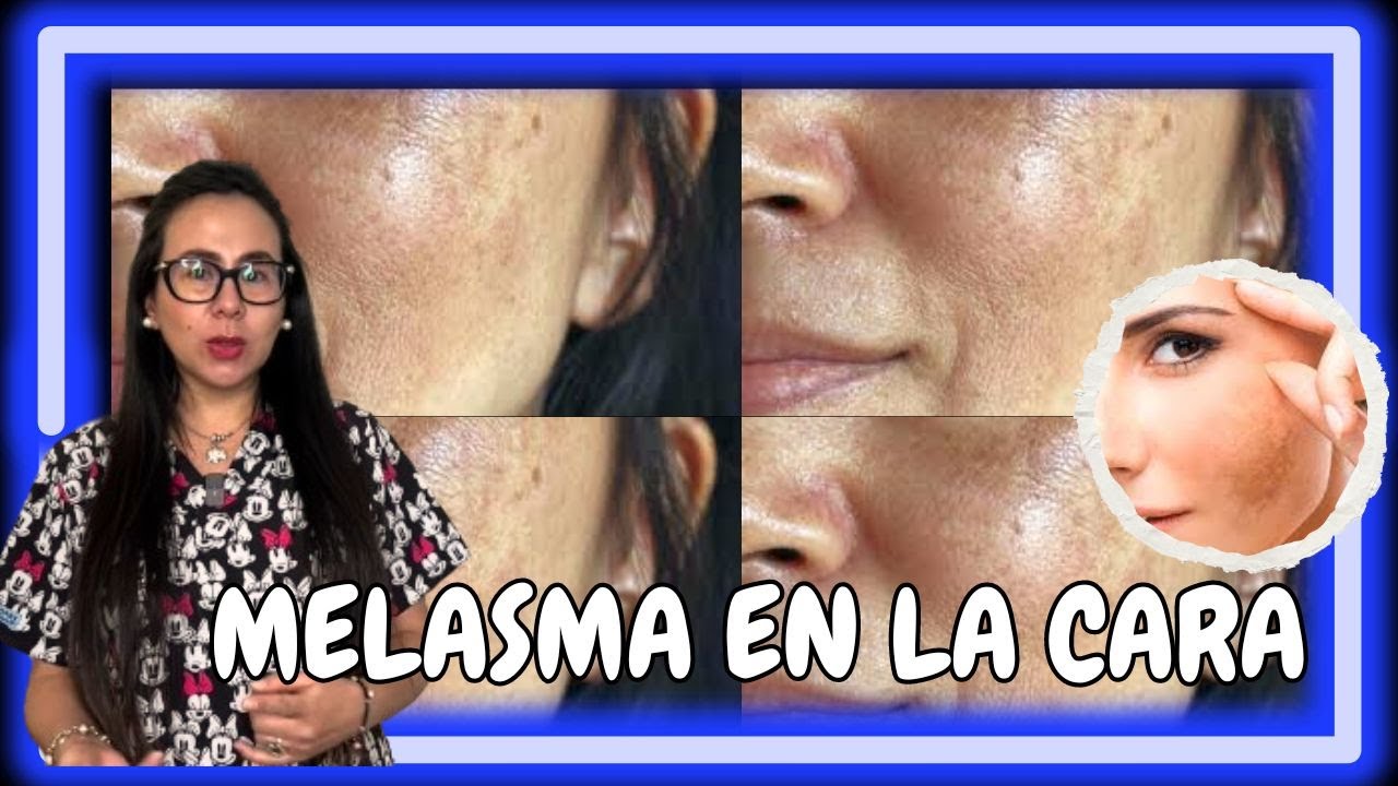 MELASMA en la CARA: Tratamiento dermatológico I JAVI DERMA - YouTube