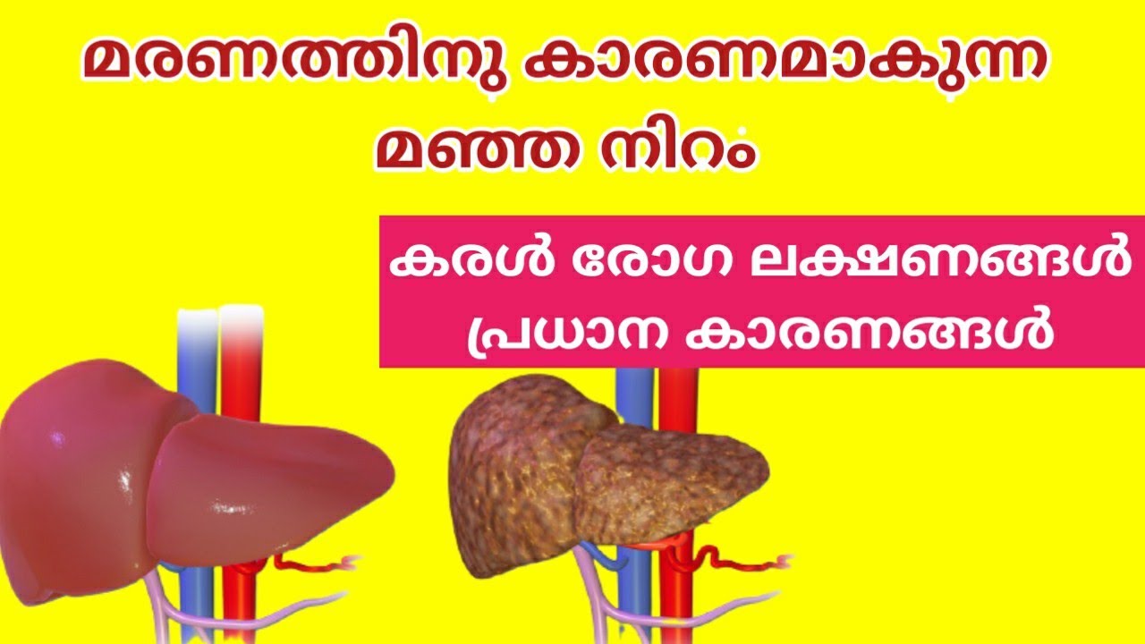 കരൾ രോഗ ലക്ഷണങ്ങൾ|നിങ്ങളുടെ കരൾ ശരിയായി പ്രവർത്തിക്കുന്നുണ്ടോ|Liver ...