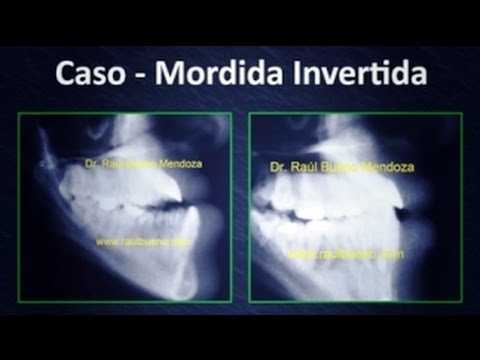 Caso: Mordida Invertida - Maloclusión Clase III - Underbite - Occlusion ...